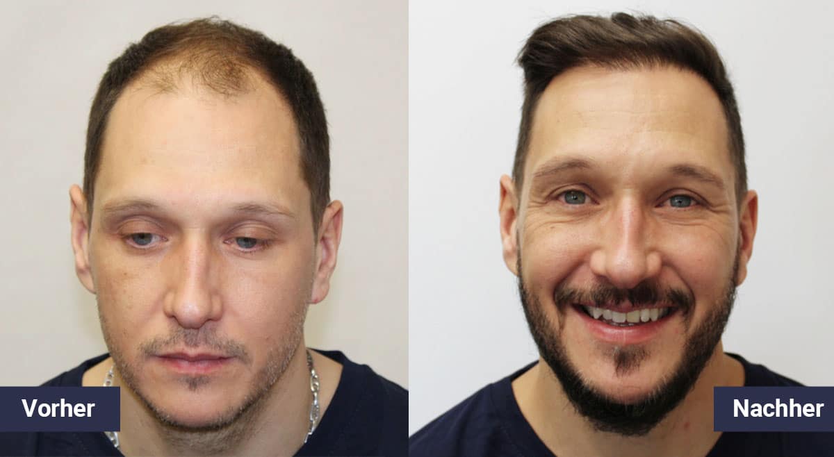 FUE-Haartransplantation: Was zu erwarten, Kosten, Ergebnisse und mehr